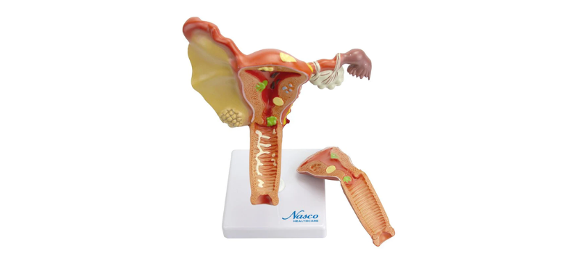 Μοντέλα Ανατομίας: Female Genital Organ with Pathology Model, 2 Parts